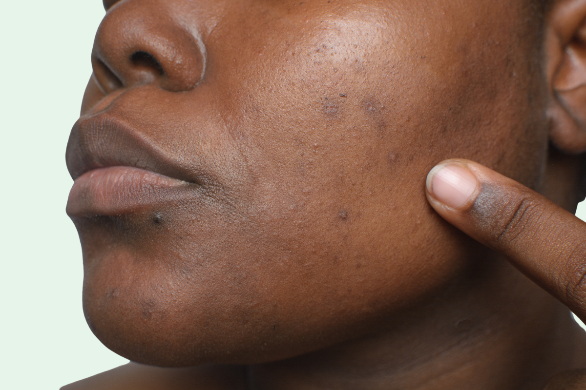 The Ultimate Guide to Vitamin C: Your Secret Weapon Against Hyperpigme ...